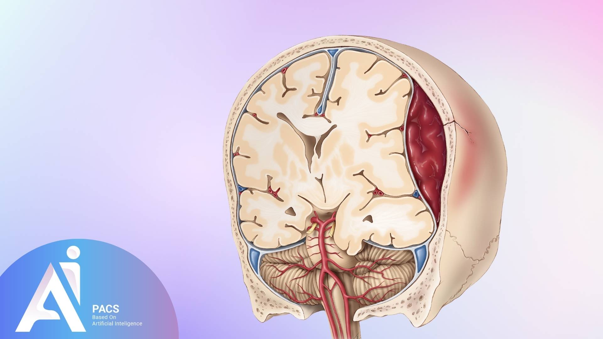 Epidural Hematoma (EDH) on Brain CT Scan: Quick Medical Guide