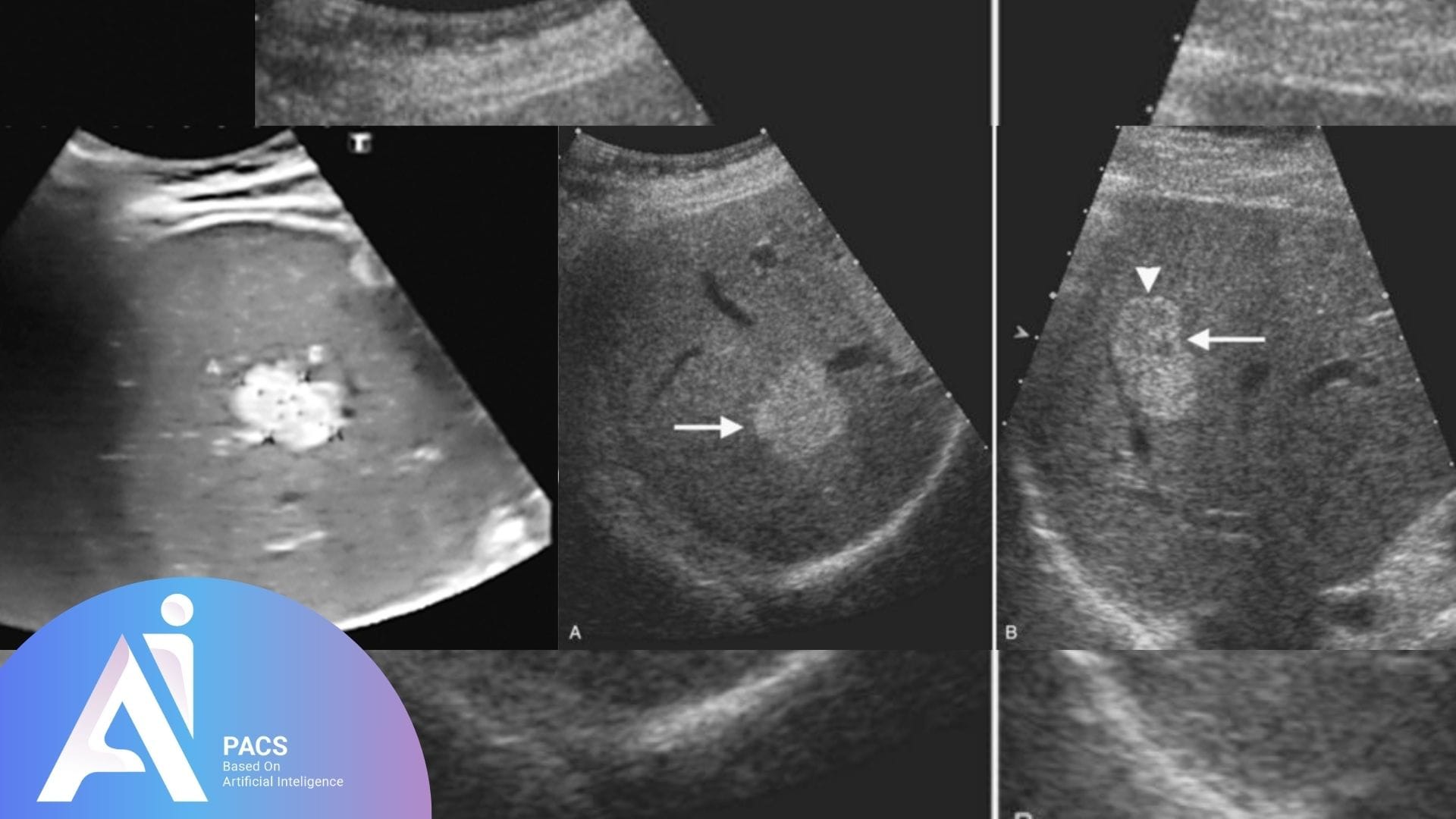 Hyperechoic Lesion in Ultrasound: Meaning, Causes & Examples | AI-PACS