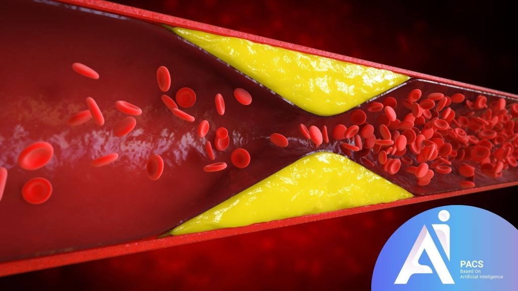 Deep Vein Thrombosis (DVT) on Ultrasound: What Is It?