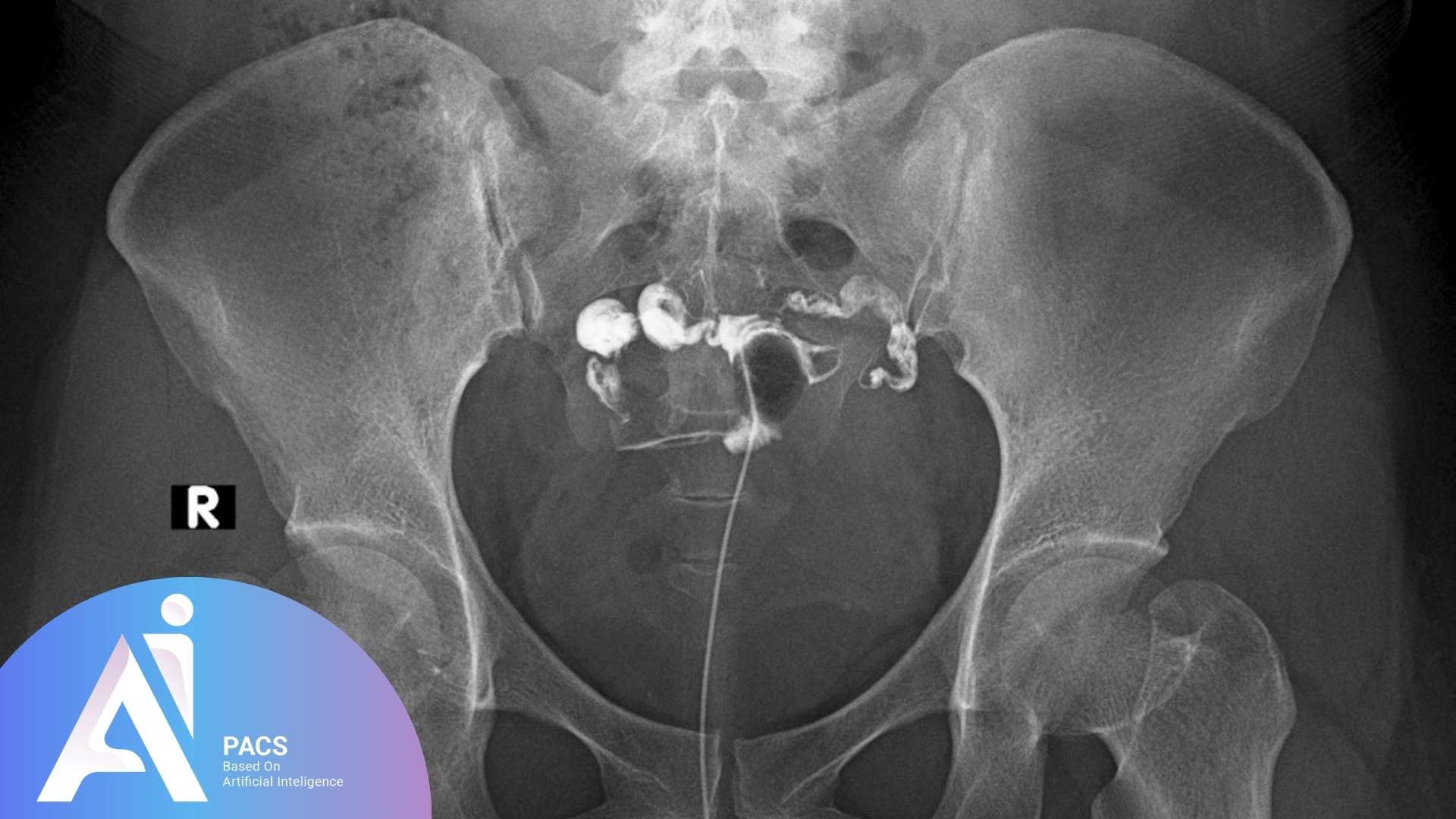 Hysterosalpingography (HSG): The Key to Evaluating Fertility